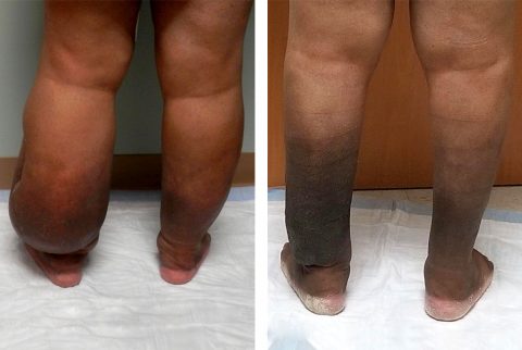 Before & After Results - Lymphedema & Wound Care Consultants