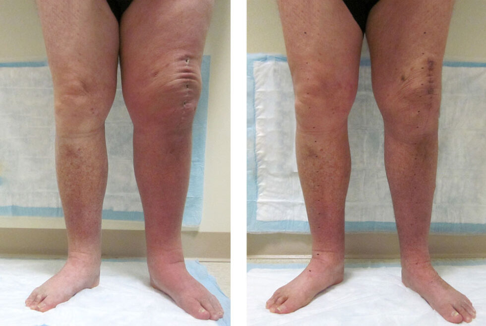 Before & After Results - Lymphedema & Wound Care Consultants